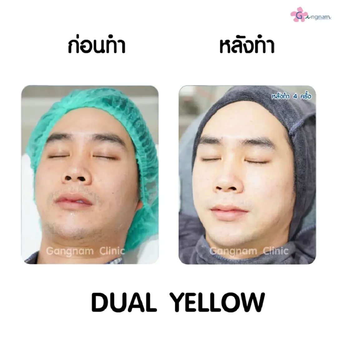 Dual yellow Laser ช่วยแก้ปัญหาผิวหน้าได้อย่างไร มีข้อควรระวังอะไรบ้าง?