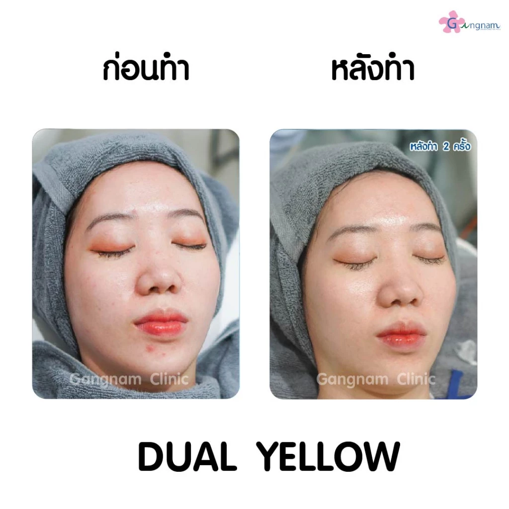 Dual yellow Laser ช่วยแก้ปัญหาผิวหน้าได้อย่างไร มีข้อควรระวังอะไรบ้าง?