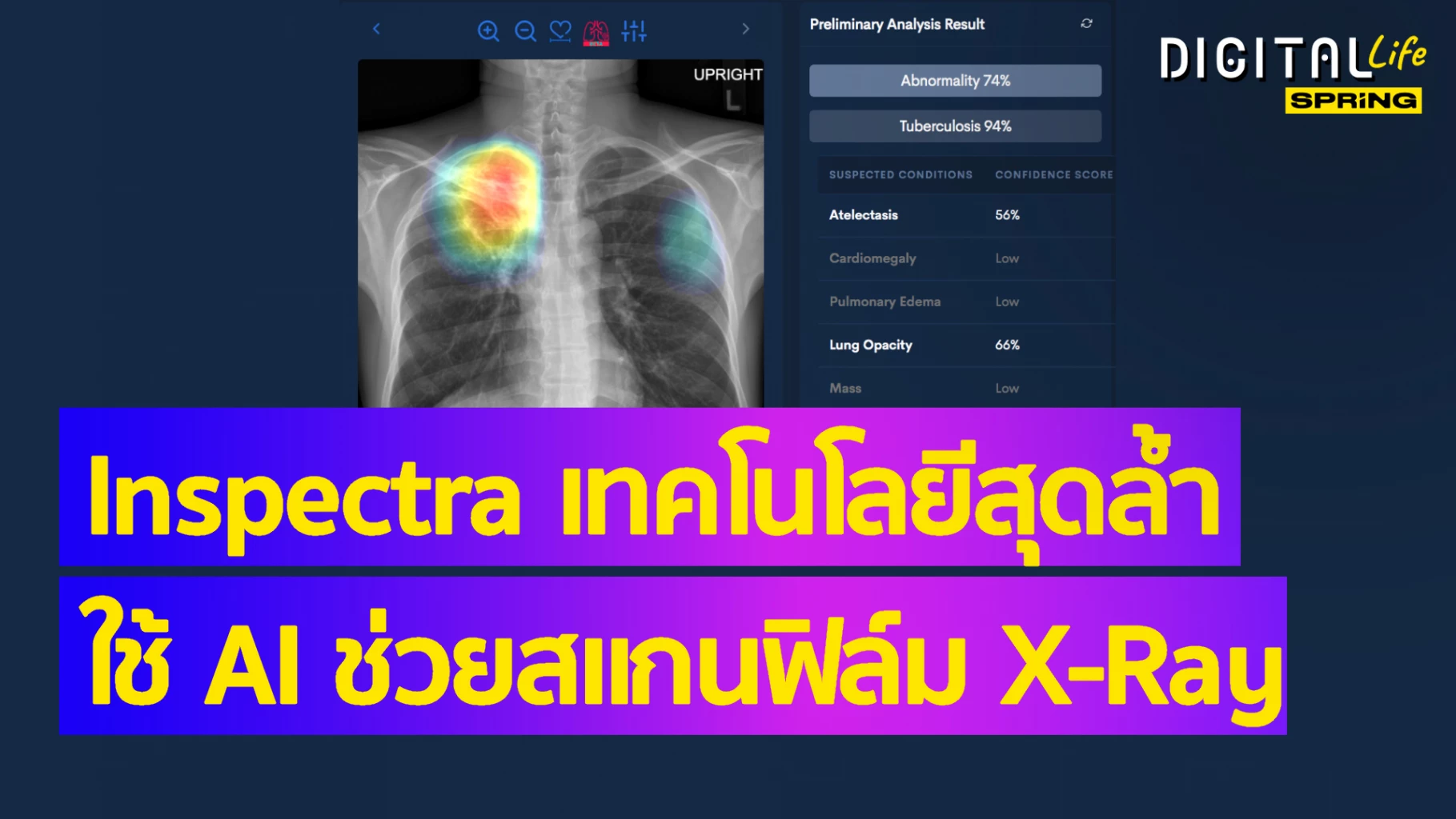 เทคโนโลยีการแพทย์สุดล้ำ Inspectra อ่านฟิล์มเอ็กซ์เรย์ด้วยระบบ AI