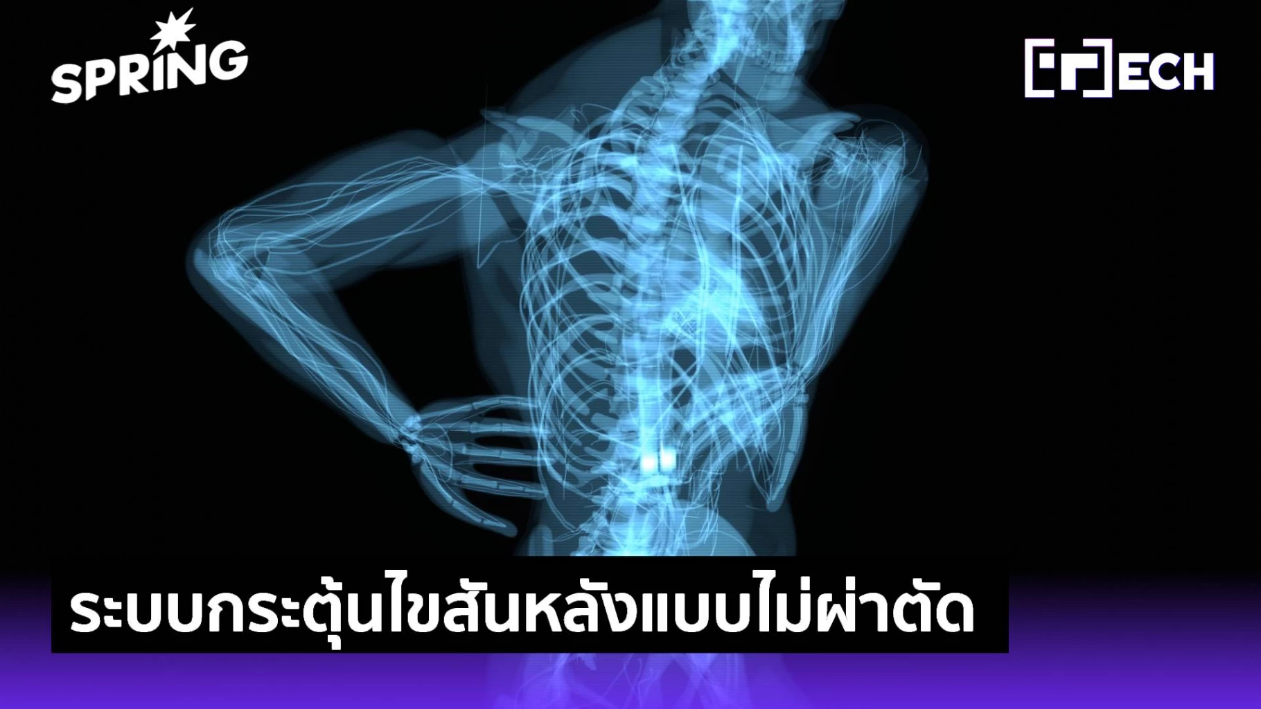 ARC-EX System : ฟื้นฟูผู้ป่วยอัมพฤกษ์ ด้วยระบบกระตุ้นไขสันหลังแบบไม่ผ่าตัด