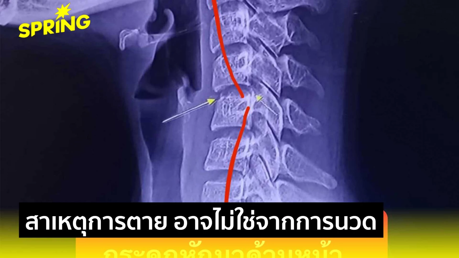 ผลเอกซเรย์ ผิง ชญาดา ไม่พบกระดูกทับสันหลัง การเสียชีวิตอาจไม่ใช่เพราะนวด